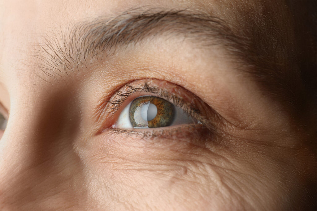 10 Rare and Bizarre Eye Conditions - LASIK Denver | Cataract Surgery